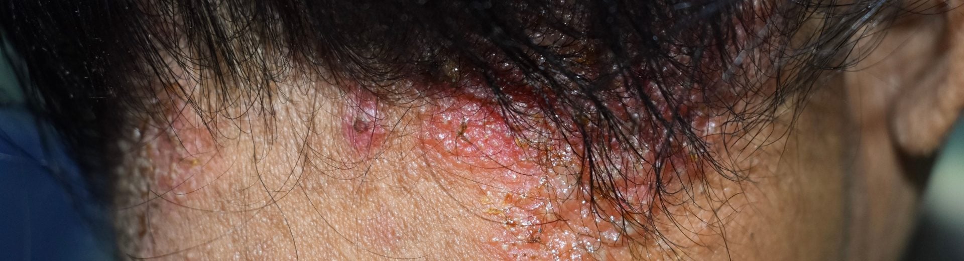 Qué es la tiña o dermatofitosis y qué tipos hay